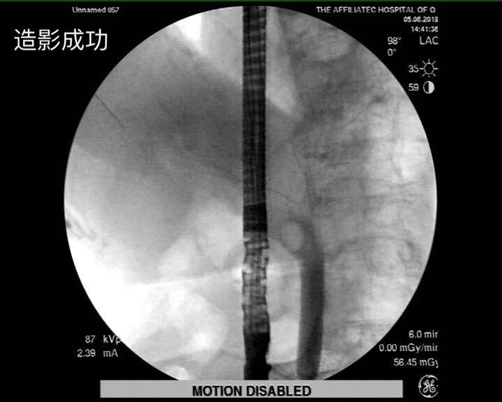 西海岸院区消化内科运用ERCP成功治愈94岁高龄患者 - 青岛大学附属医院